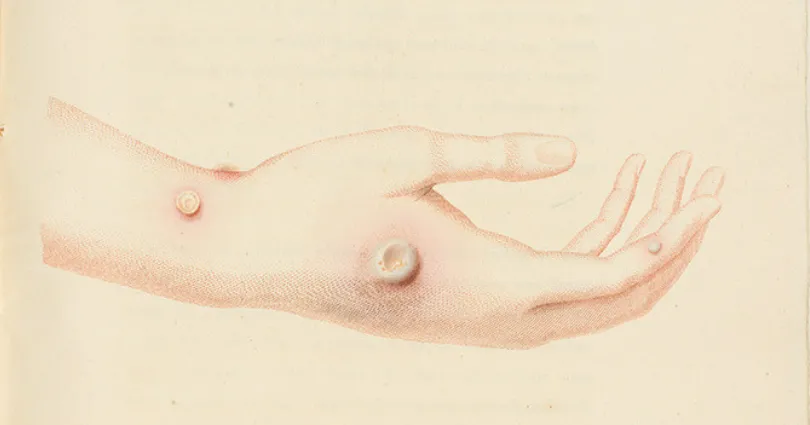 how did smallpox inoculation work